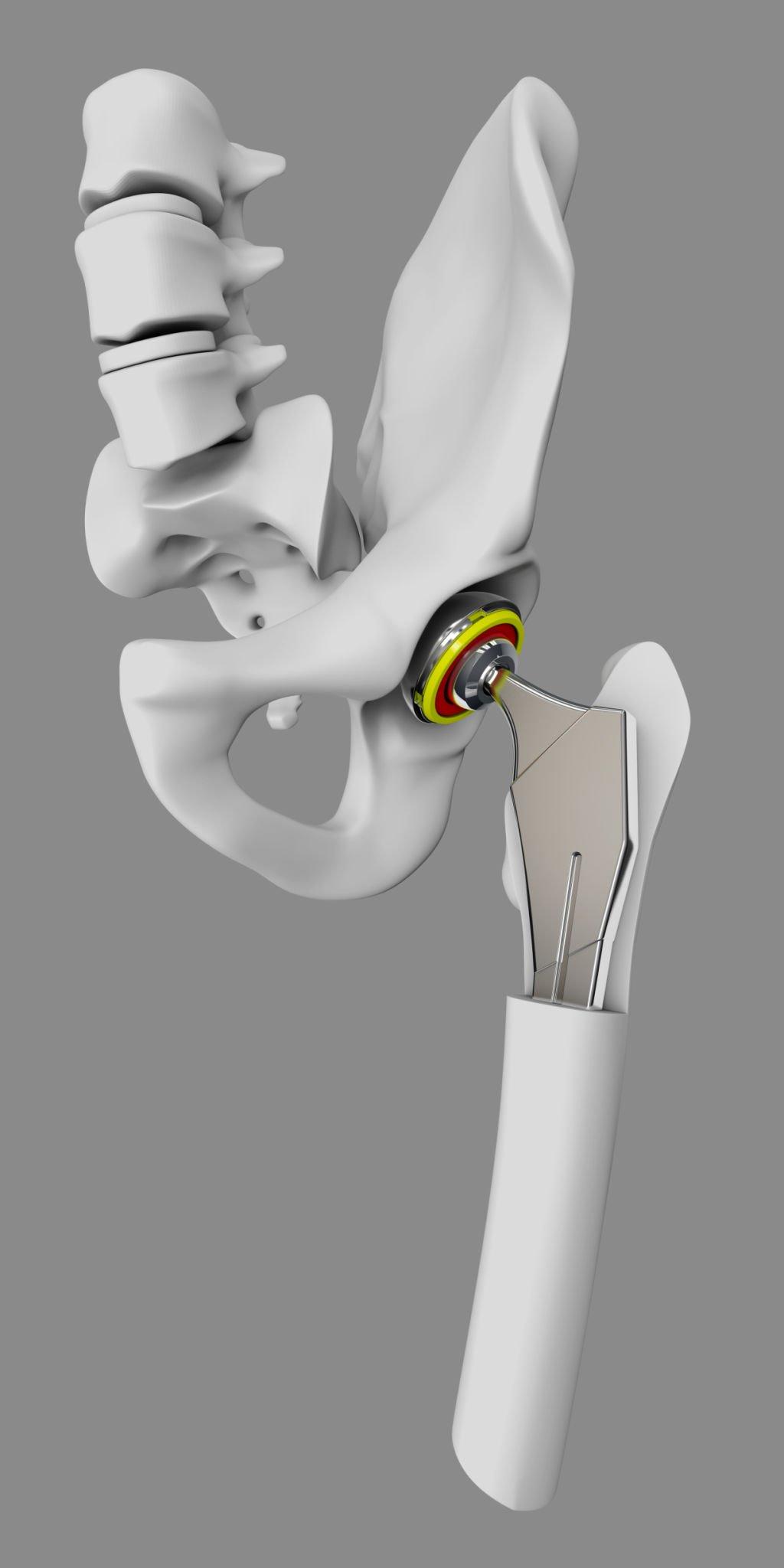 Orthopedics Kerala – Enhancing Mobility